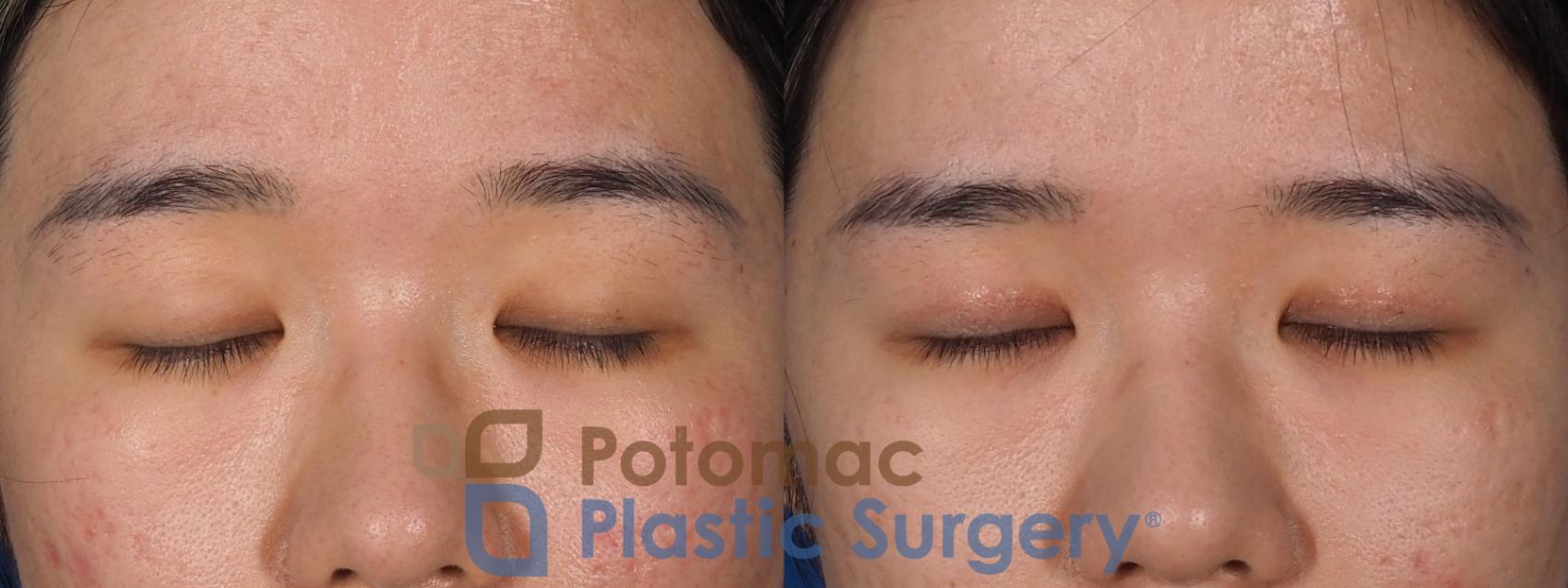 Double eyelid surgery in young woman by Dr. Chaboki