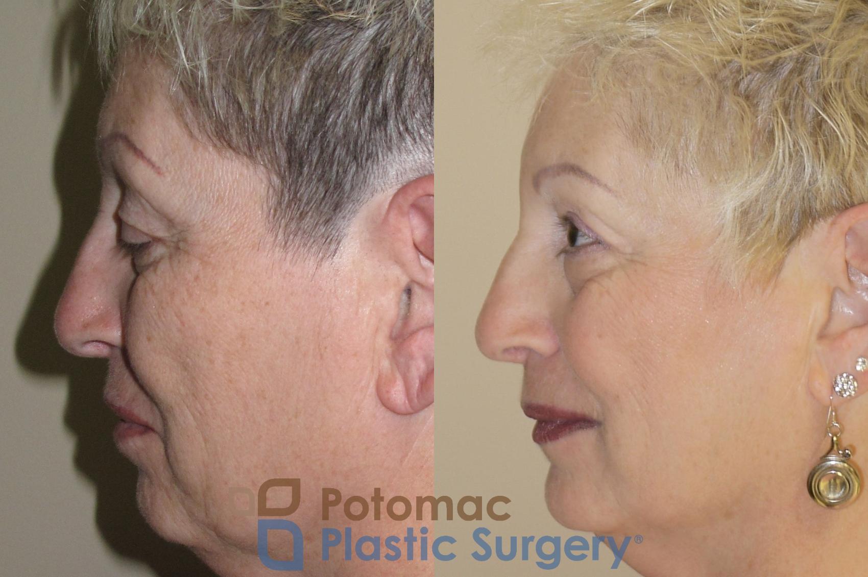 Brow Lift Before & After Photos Patient 28 | Washington DC & Arlington ...