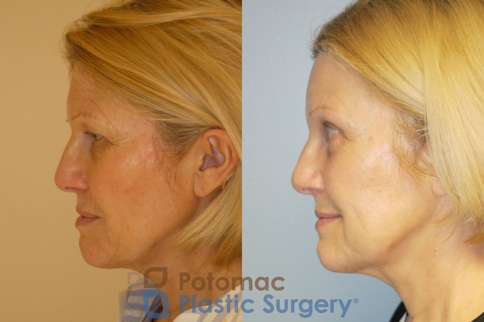 Brow lift and blepharoplasty with fat transfer to rejuvenate the ...