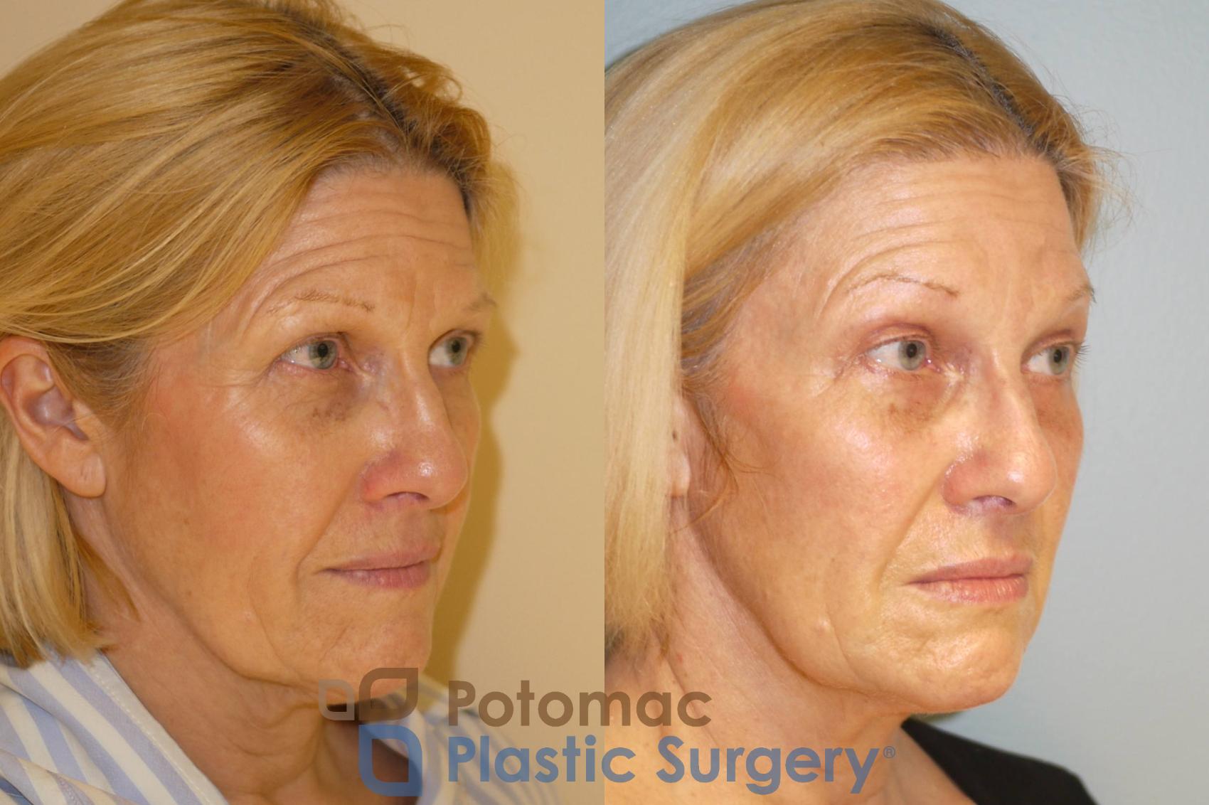 Brow lift and blepharoplasty with fat transfer to rejuvenate the ...