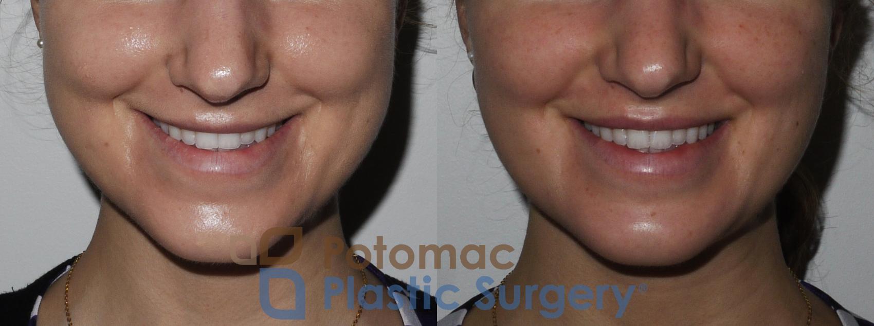 Buccal fat reduction to slim the face of a younger female