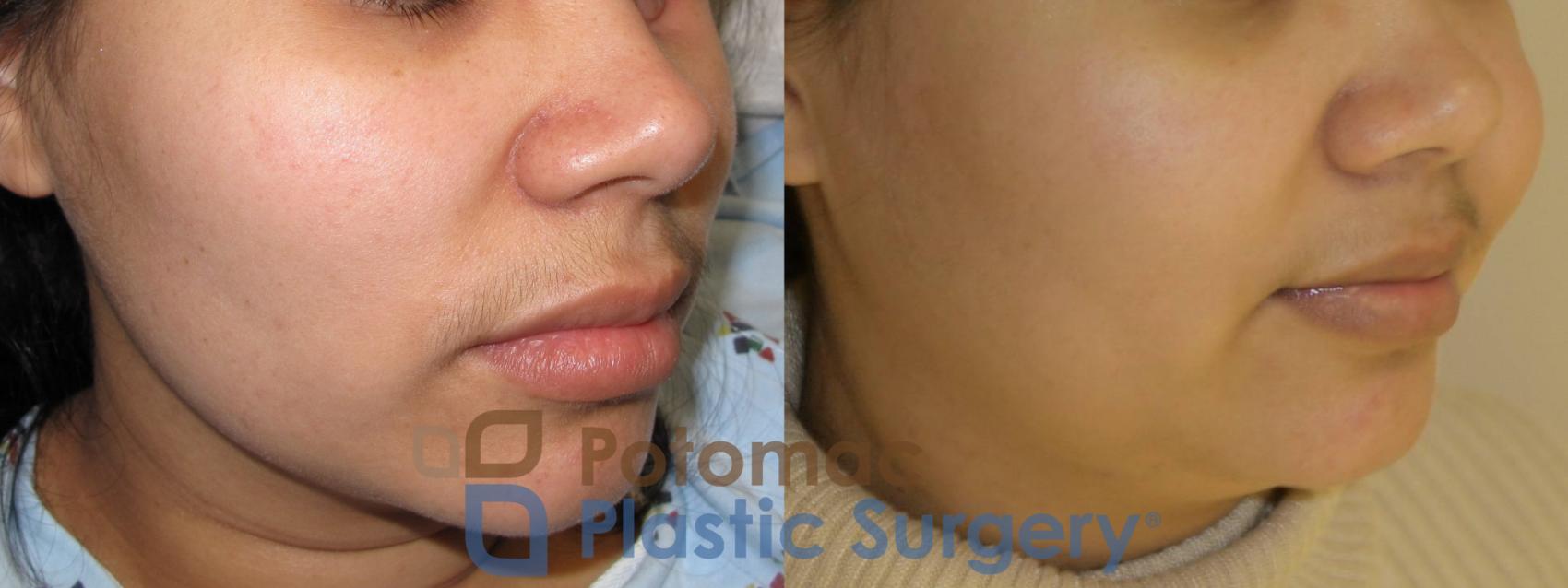 Cheek Augmentation Before & After Photos Patient 41 | Washington DC ...