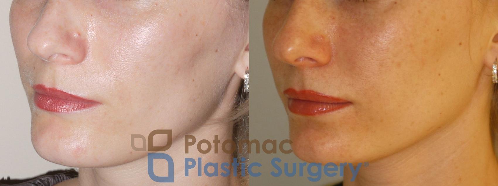 Cheek Augmentation Before & After Photos Patient 74 | Washington DC ...