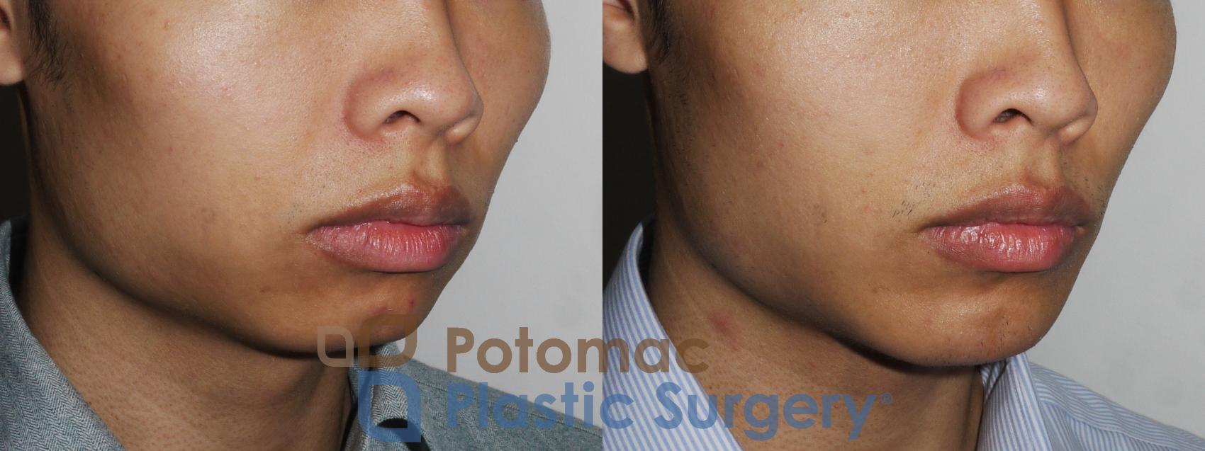 Chin Augmentation Before & After Photos Patient 187 | Washington DC ...