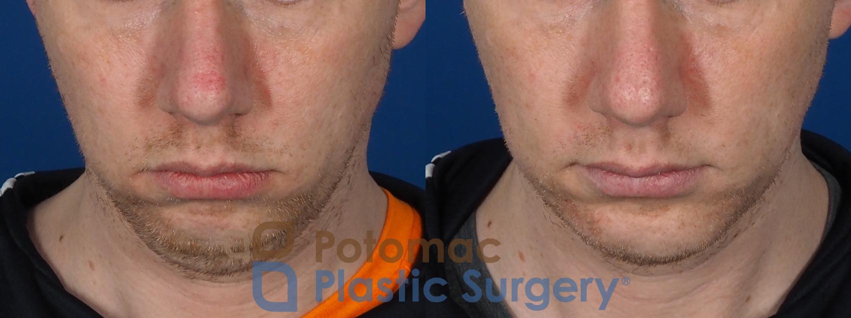 Chin Augmentation Before & After Photos Patient 272 | Washington DC ...