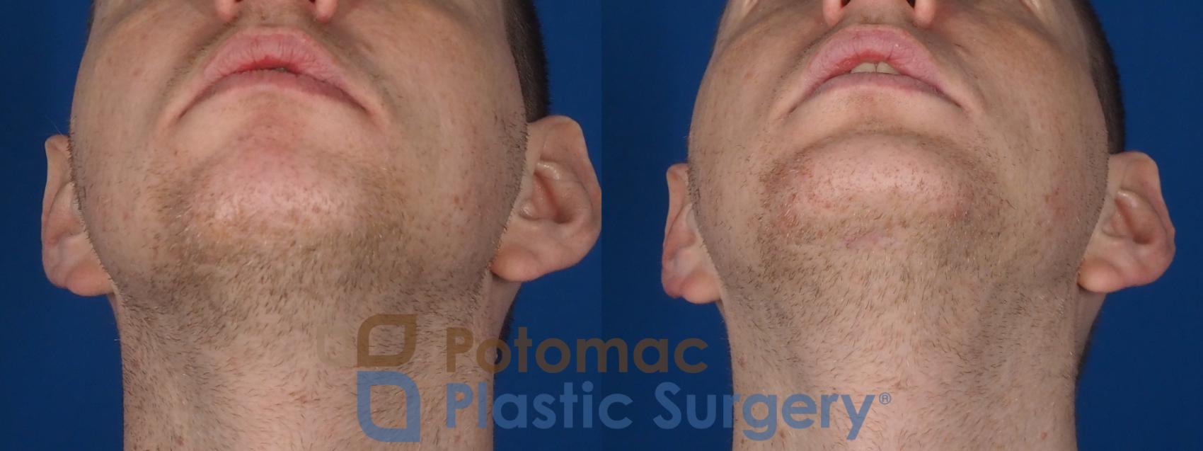 Chin Augmentation Before & After Photos Patient 272 | Washington DC ...