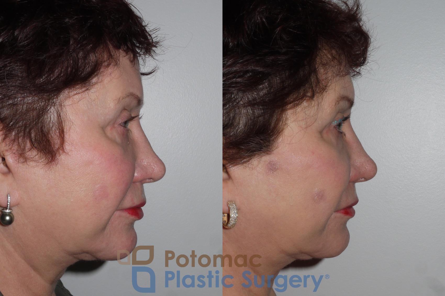 Facial fillers used to rejuvenate eyes and cheeks of an older woman