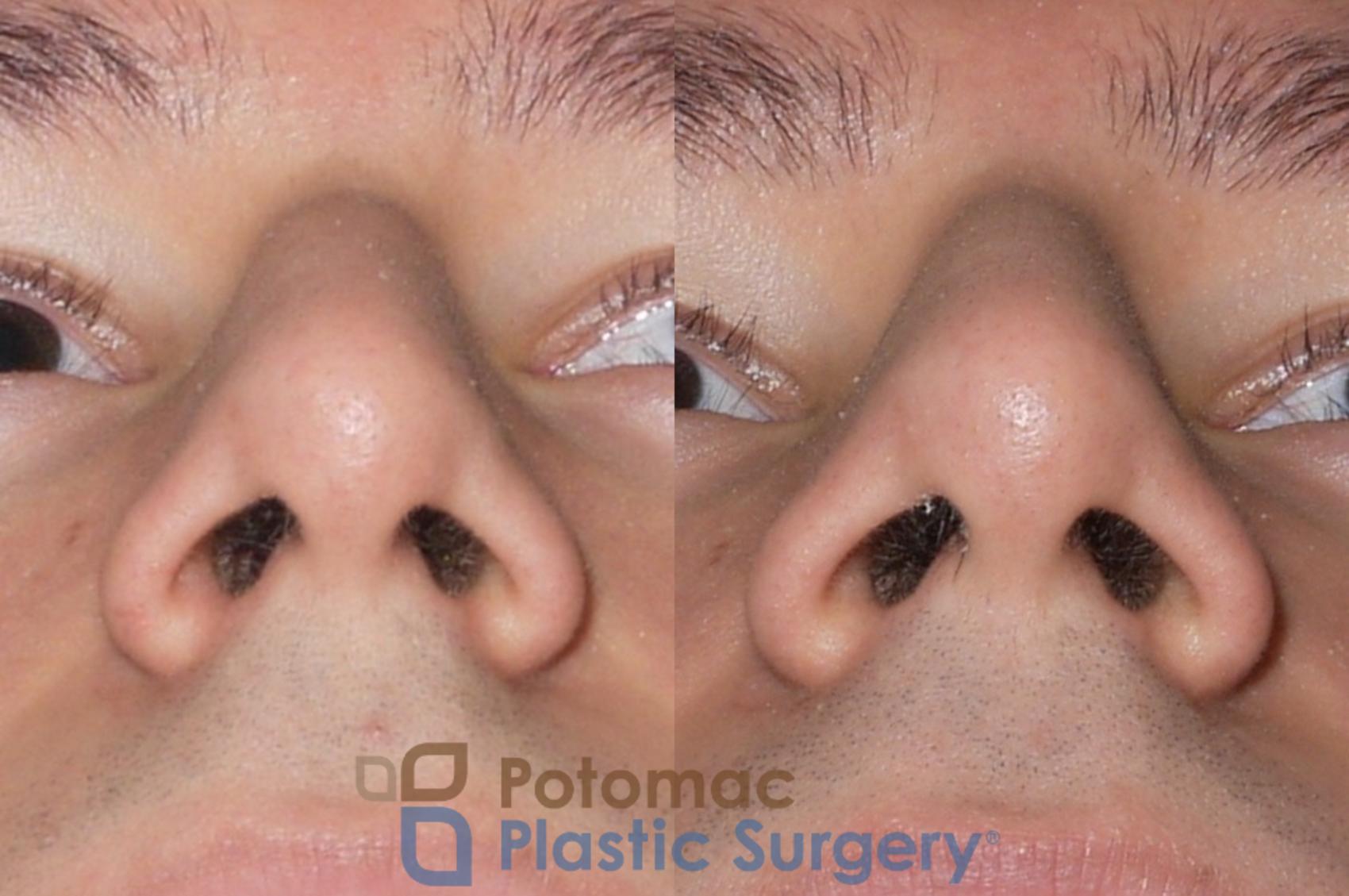 Nonsurgical Rhinoplasty with dermal filler to improve the nasal bridge ...