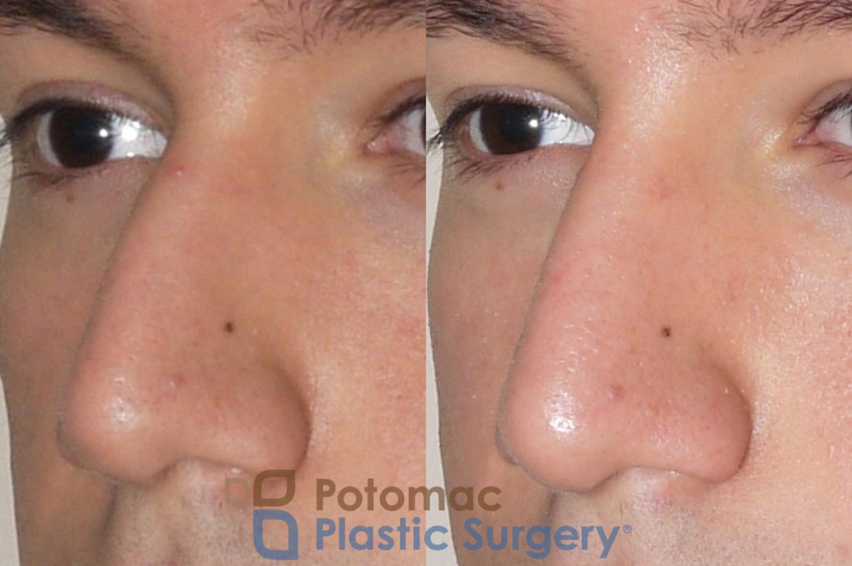 Nonsurgical Rhinoplasty with dermal filler to improve the nasal bridge ...