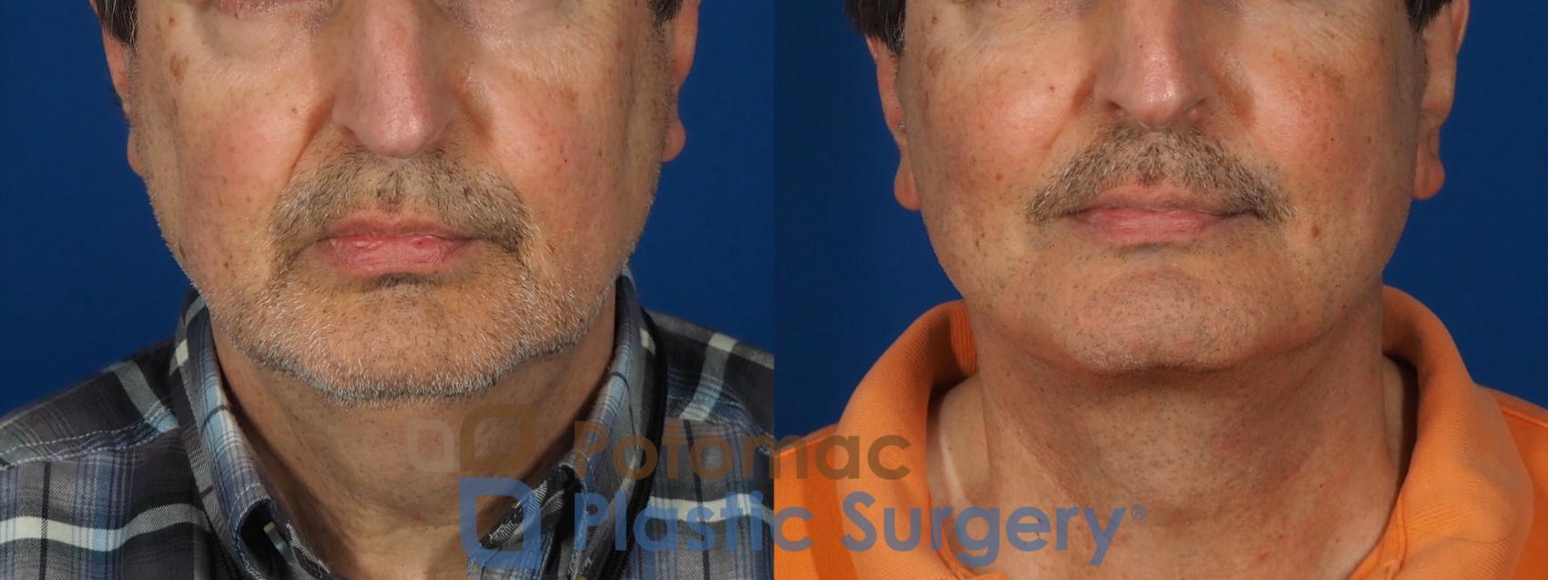 Cheek Augmentation Before & After Photo Gallery | Washington, DC ...