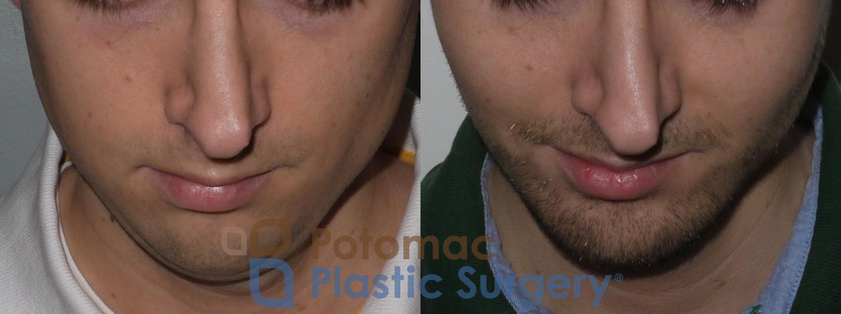 Facial Sculpting Before & After Photos Patient 135 | Washington DC ...