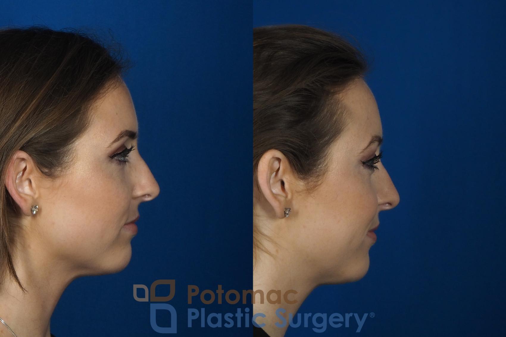 Neuromodulator used in the masseter to slim the jawline of a younger woman