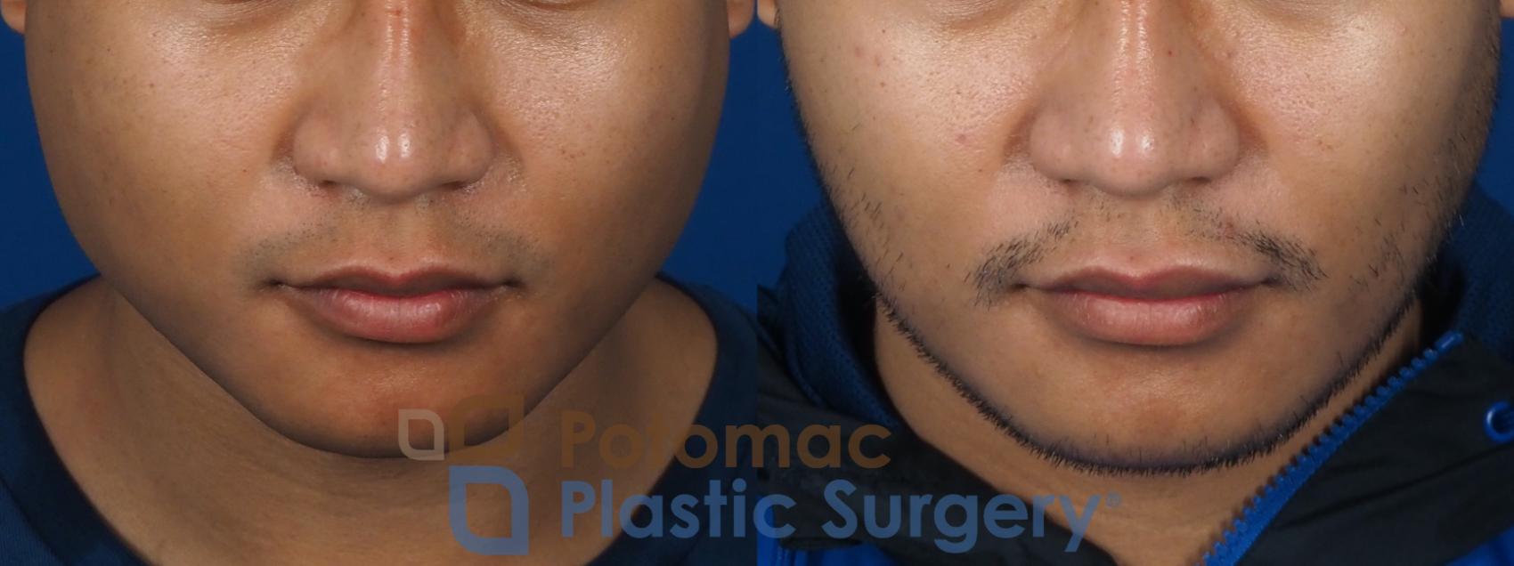 Masseter reduction using neuromodulator injections to sculpt the ...