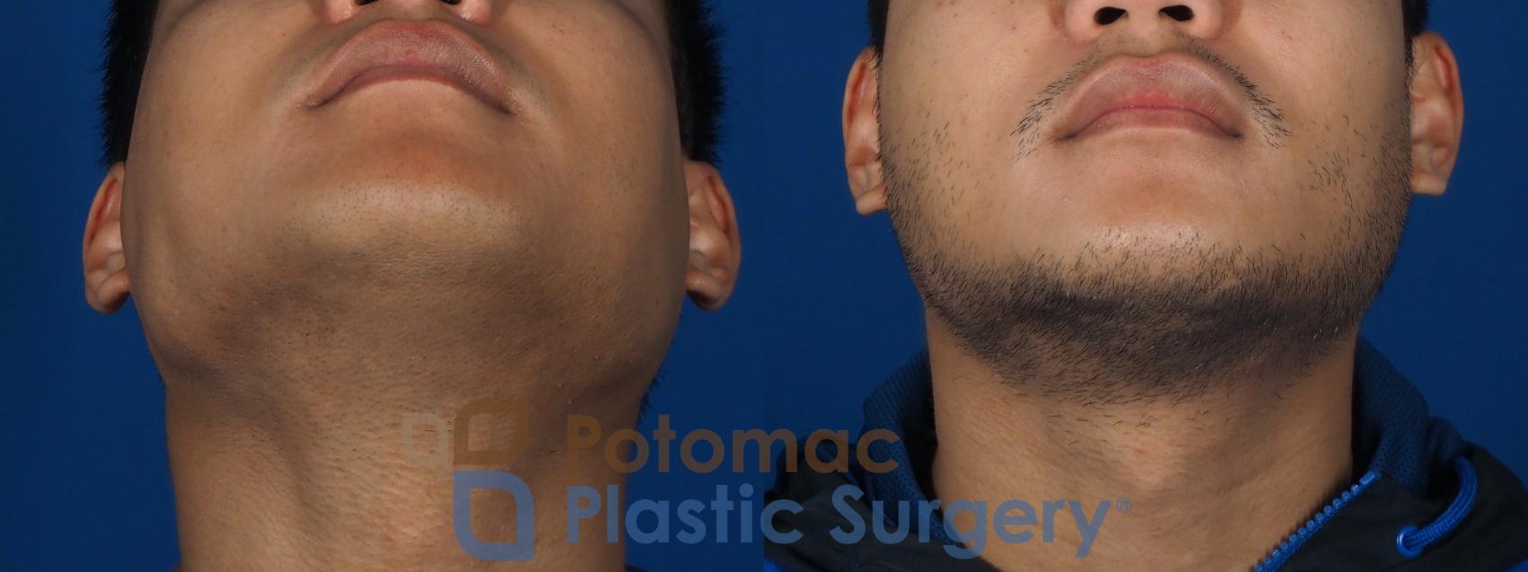 Masseter reduction using neuromodulator injections to sculpt the ...