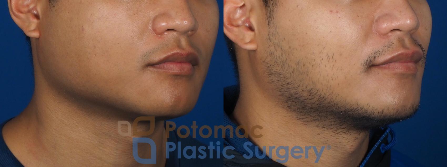 Masseter reduction using neuromodulator injections to sculpt the ...