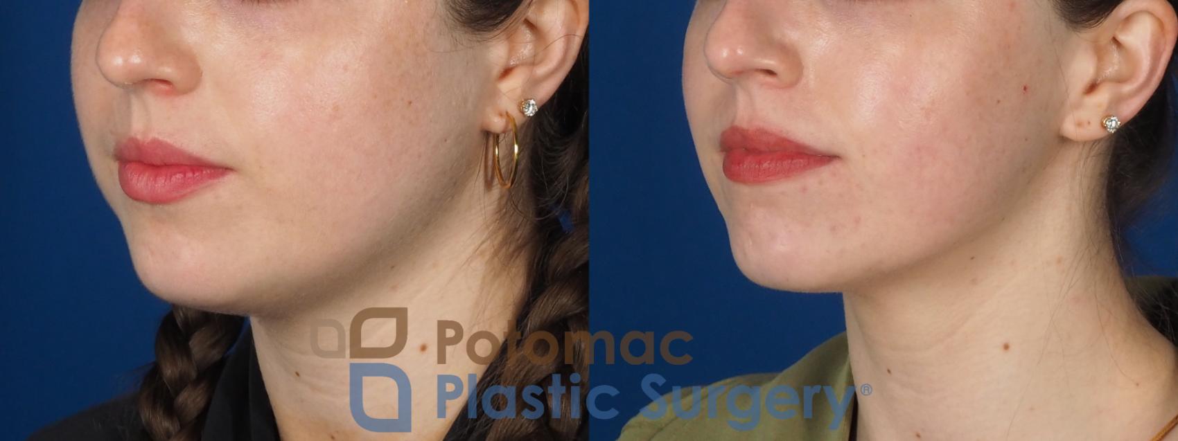 Facial Sculpting Before & After Photos Patient 317 | Washington DC ...