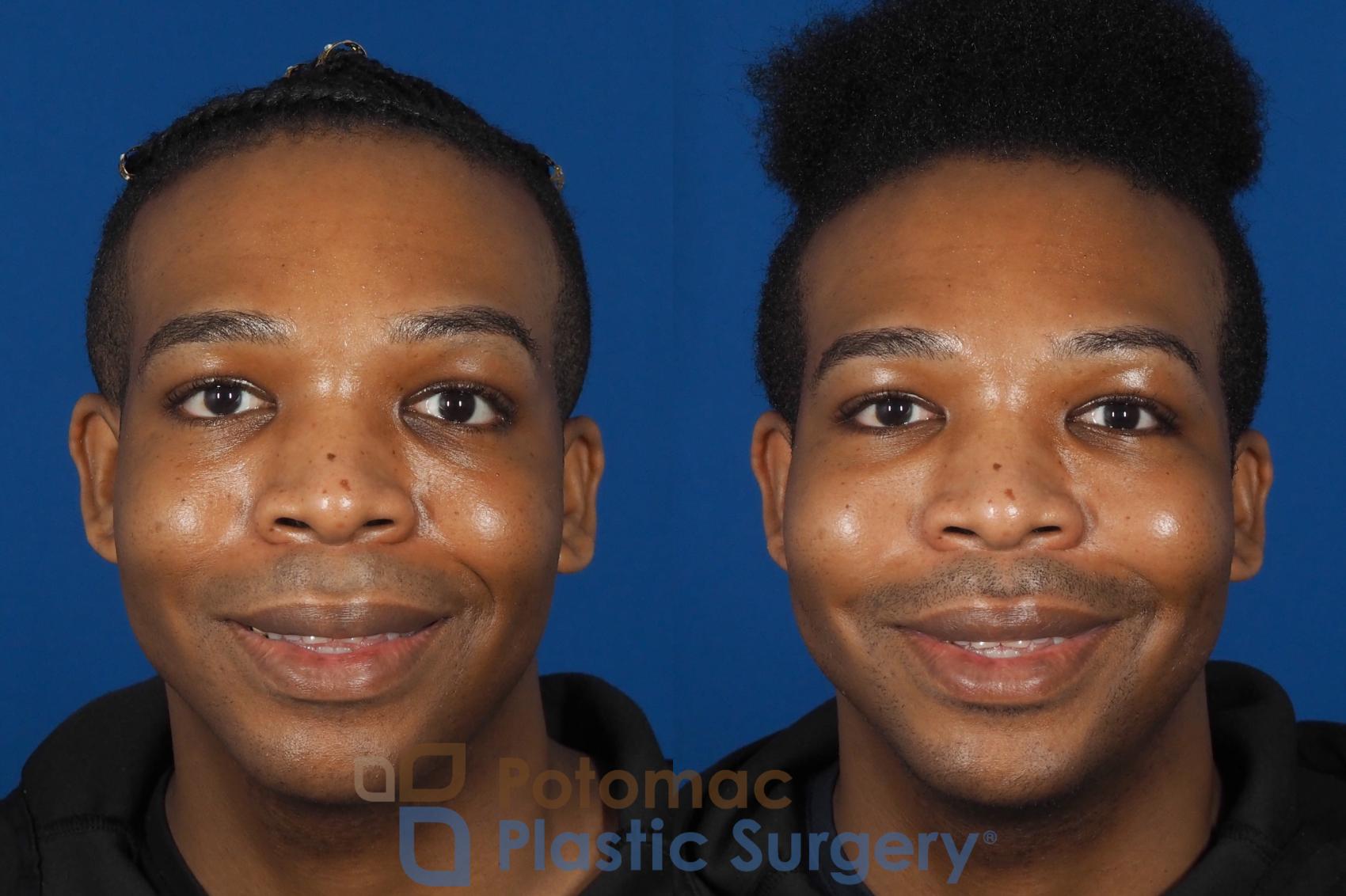 Fat Transfer Before & After Photos Patient 286 | Washington DC ...