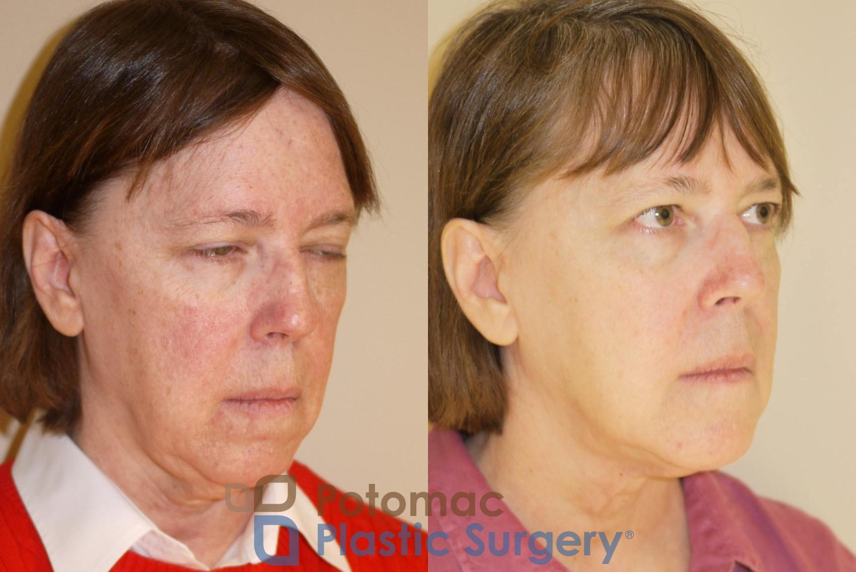 Neck Lift Before & After Photos Patient 45 | Washington DC & Arlington ...