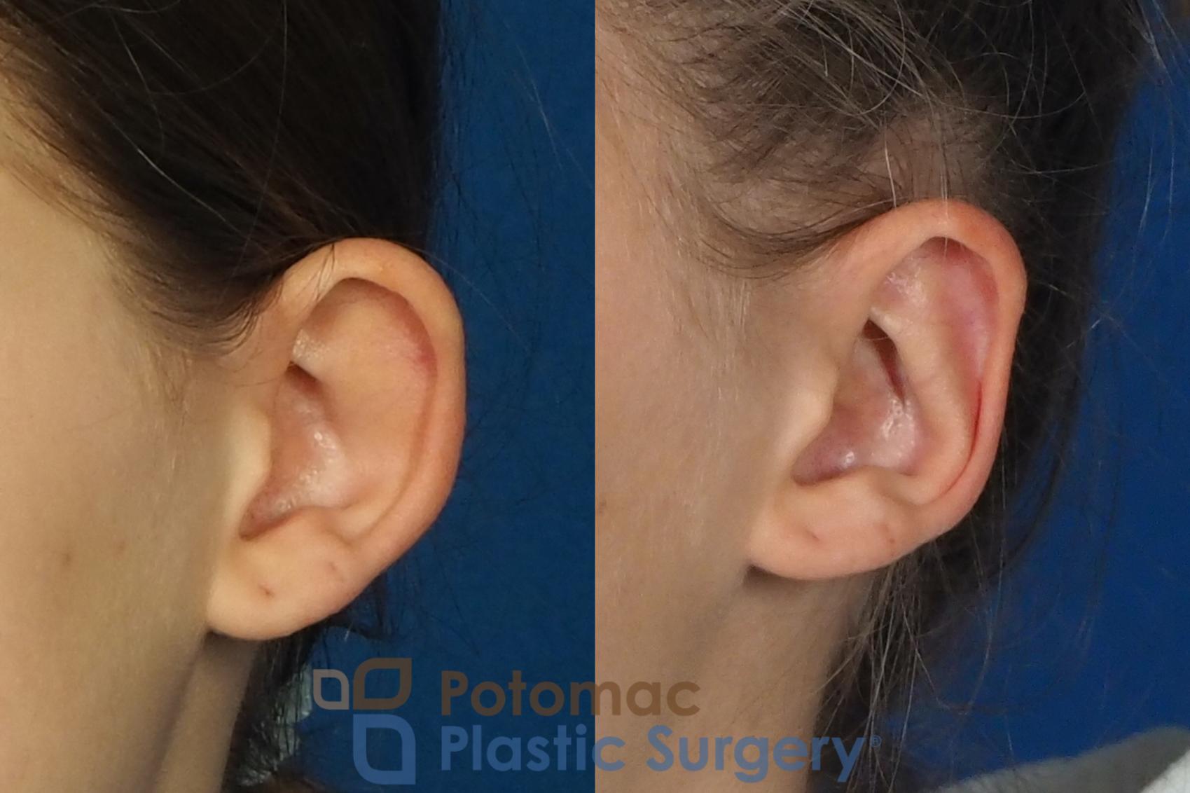 Otoplasty Before & After Photos Patient 250 | Washington DC & Arlington ...