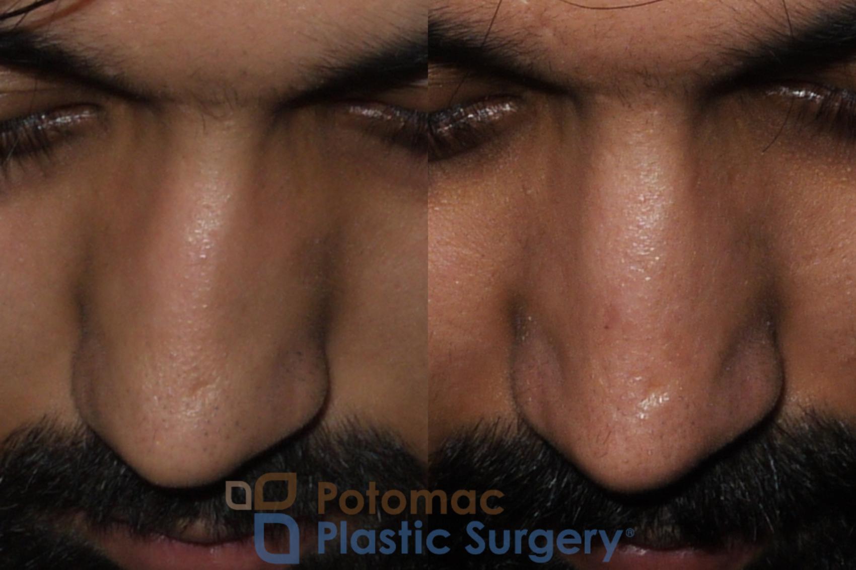 Rhinoplasty - Cosmetic Before & After Photos Patient 192 | Washington ...