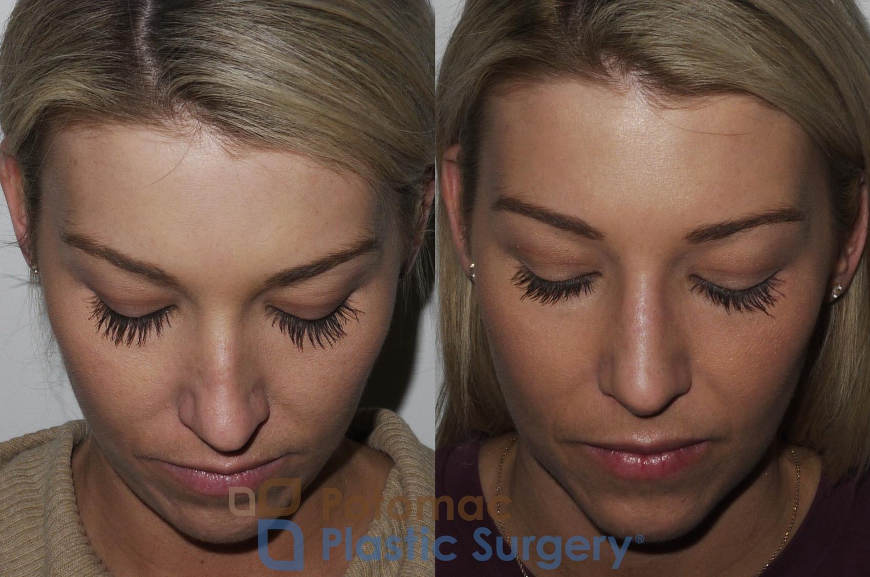 Rhinoplasty and sinus surgery to balance the shape and function of the ...