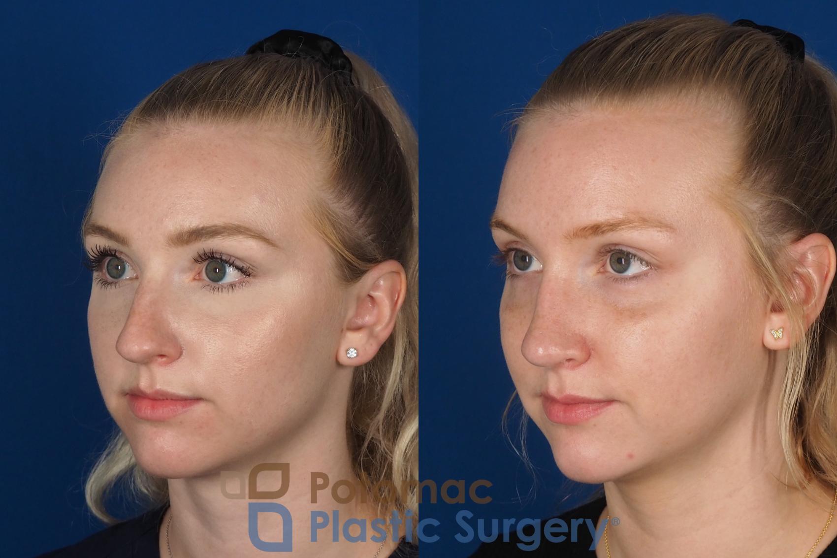 Rhinoplasty - Cosmetic Before & After Photos Patient 318 | Washington ...