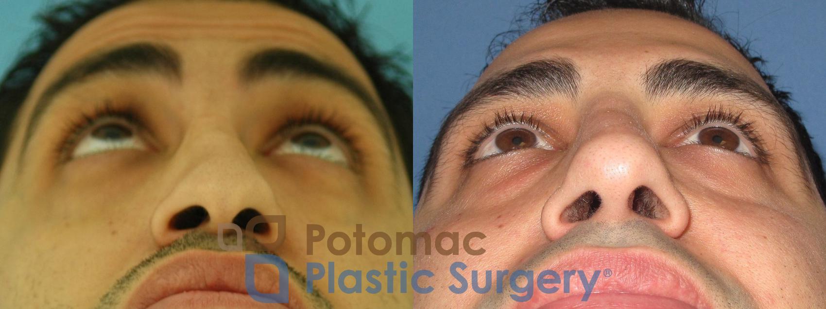 Septorhinoplasty to correct a deviated nasal septum and balance the ...
