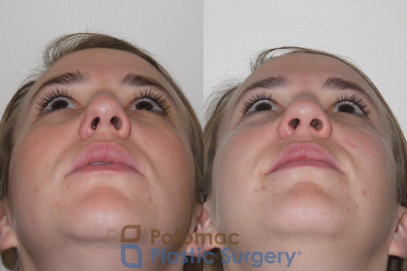 Rhinoplasty - Medical Before & After Photos Patient 98 | Washington DC ...