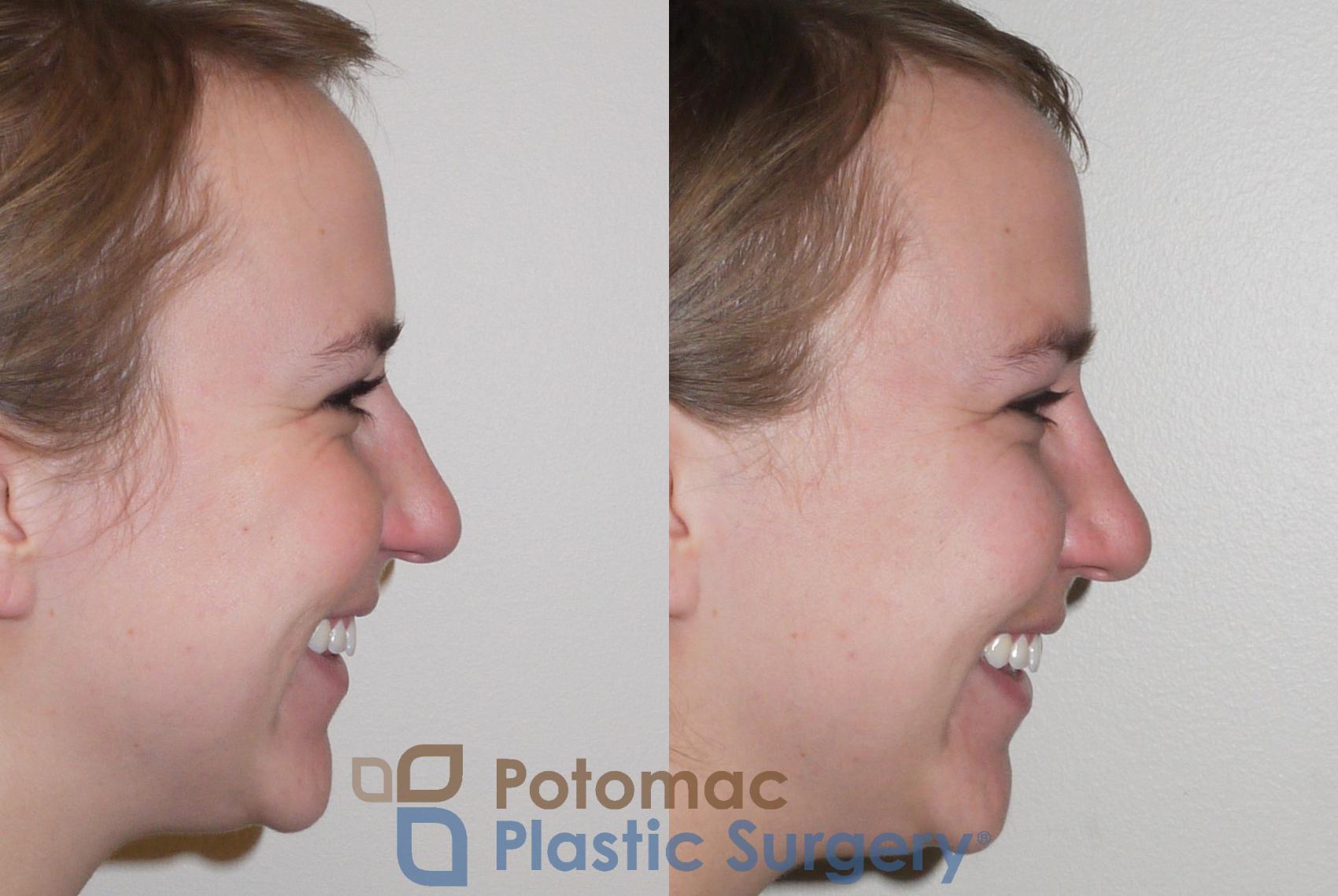 Rhinoplasty - Medical Before & After Photos Patient 98 | Washington DC ...